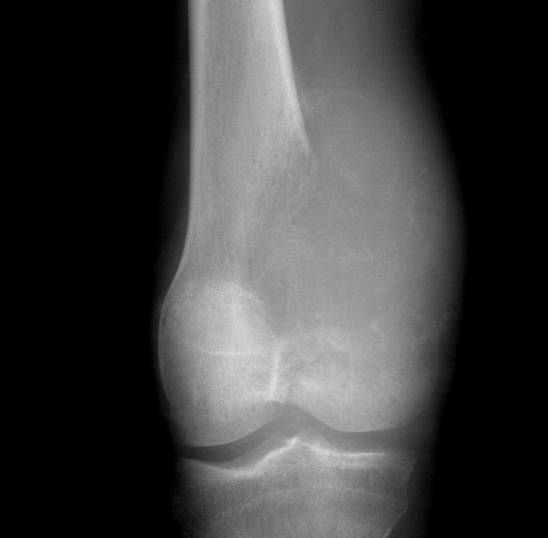 Telangiectatic Osteosarcoma Pathology Orthobullets